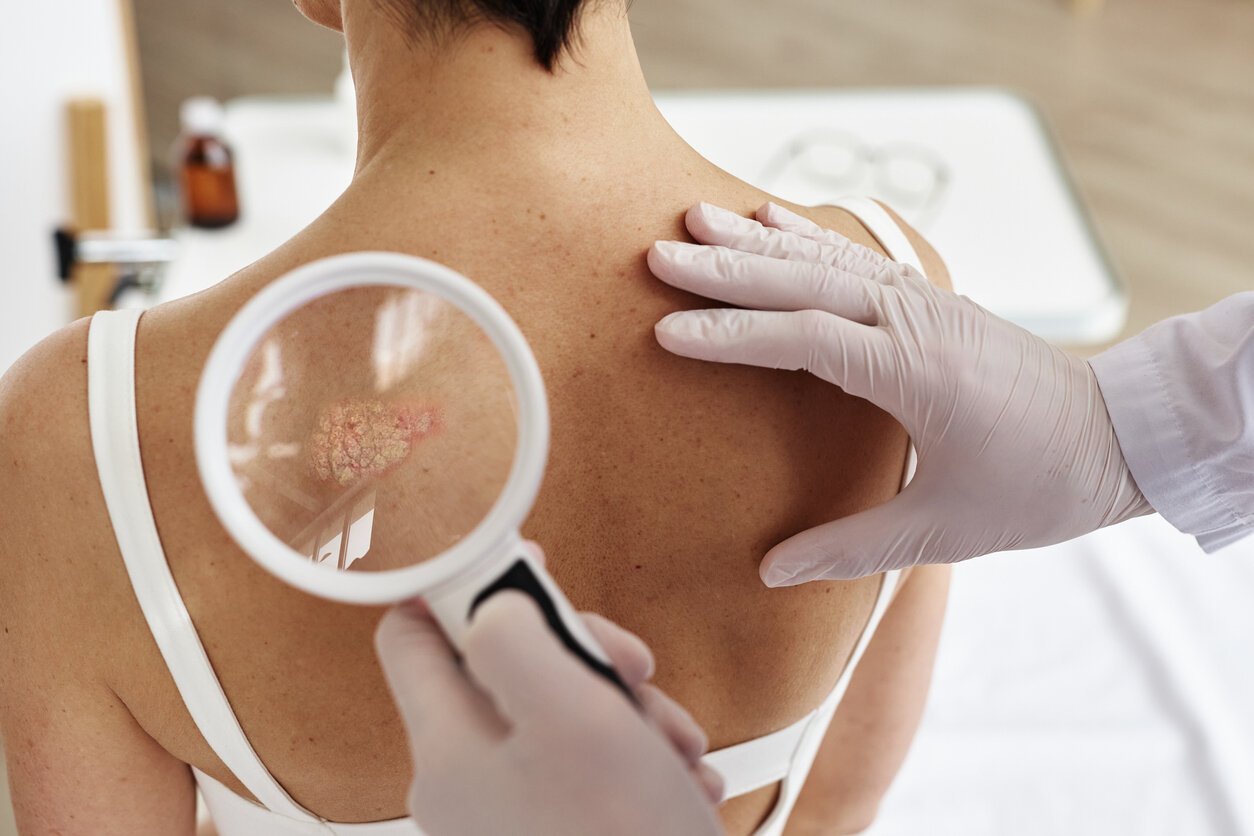 Nouvelles recommandations dans la prise en charge du psoriasis
