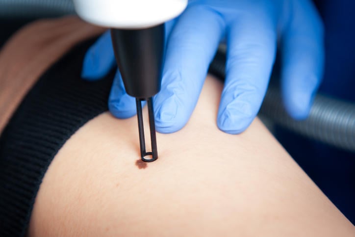 Enlever une verrue au laser : comment ça marche ? | Medisite.fr