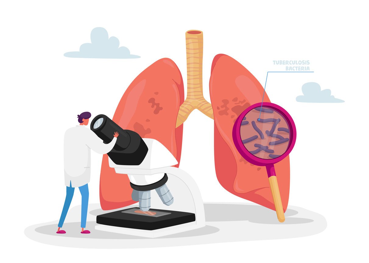 Tuberculose : un premier test de diagnostic approuvé par l'OMS ...