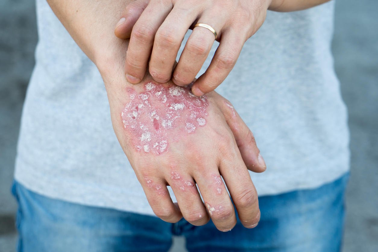 Psoriasis en gouttes, inversé, plaque : symptômes, causes, traitement